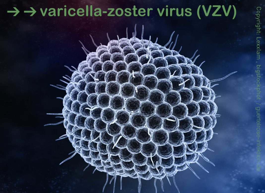 Welcher Virus löst Gürtelrose aus? » Gürtelrose Ratgeber