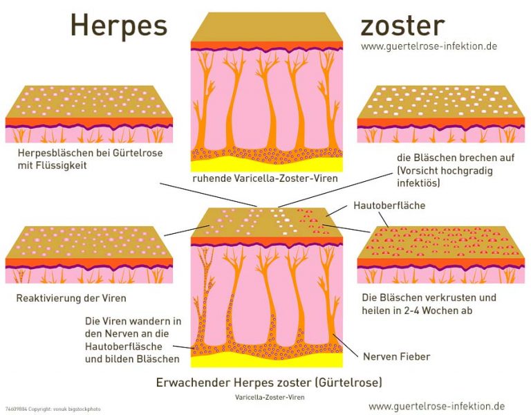 Gürtelrose Ansteckung - Gefahren und Infektionswege der Übertragung: